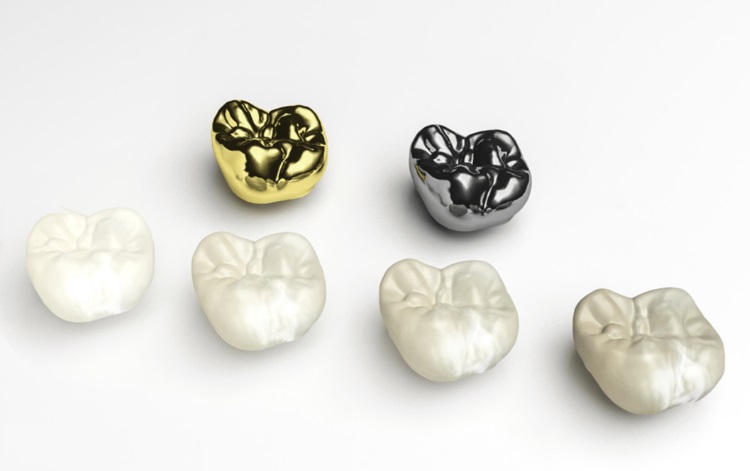 Dental Cap Cost - Identity Dentistry Canberra City